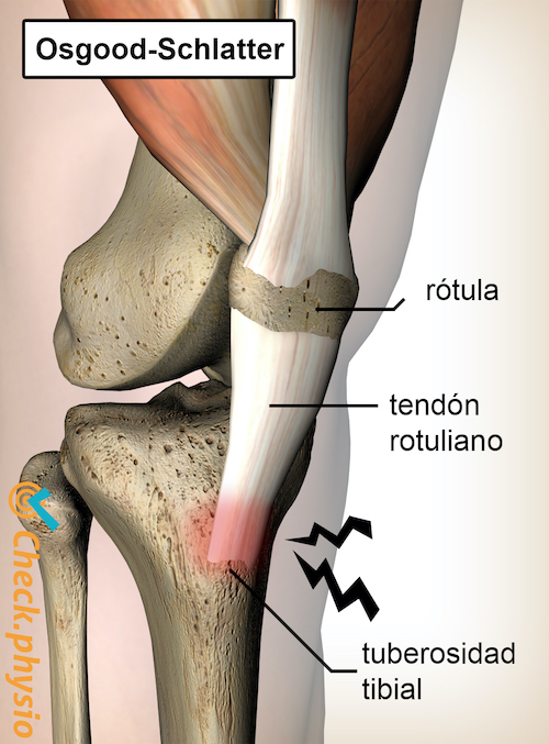 Osgood-Schlatter | Causa, síntomas y tratamiento