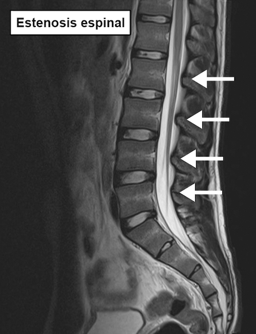 Estenosis del canal lumbar | Causa, síntomas y tratamiento