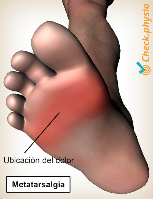 Causa, síntomas y tratamiento | Metatarsalgia - Physiocheck.com.do